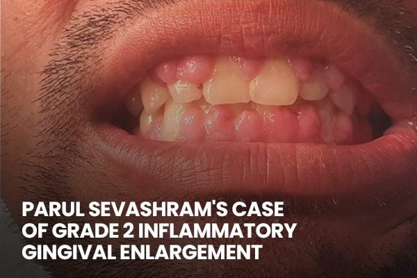Case Study: Grade 2 Inflammatory Gingival Enlargement